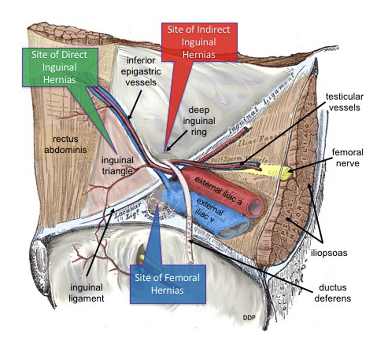 Approach to Hernias in the ED — Taming the SRU